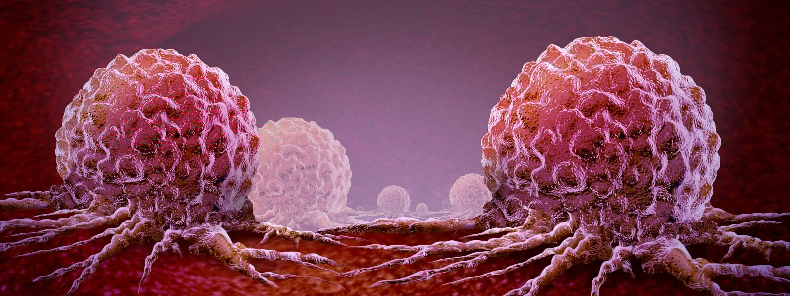 Soorten borstkanker | Pink Ribbon